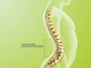 » Hiperlordose: Conheça os tipos, as formas de tratamento, as causas e ...